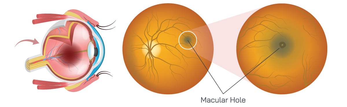 Macular Holes Miami | Retina Specialist Fort Lauderdale, FL